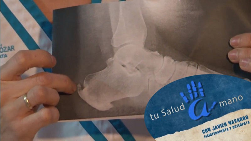 Origen y Prevención de las Calcificaciones